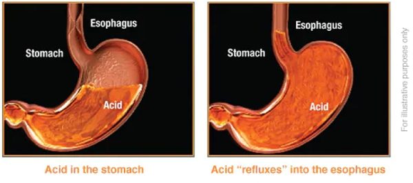 Heartburn 101 - Zegerid OTC®
